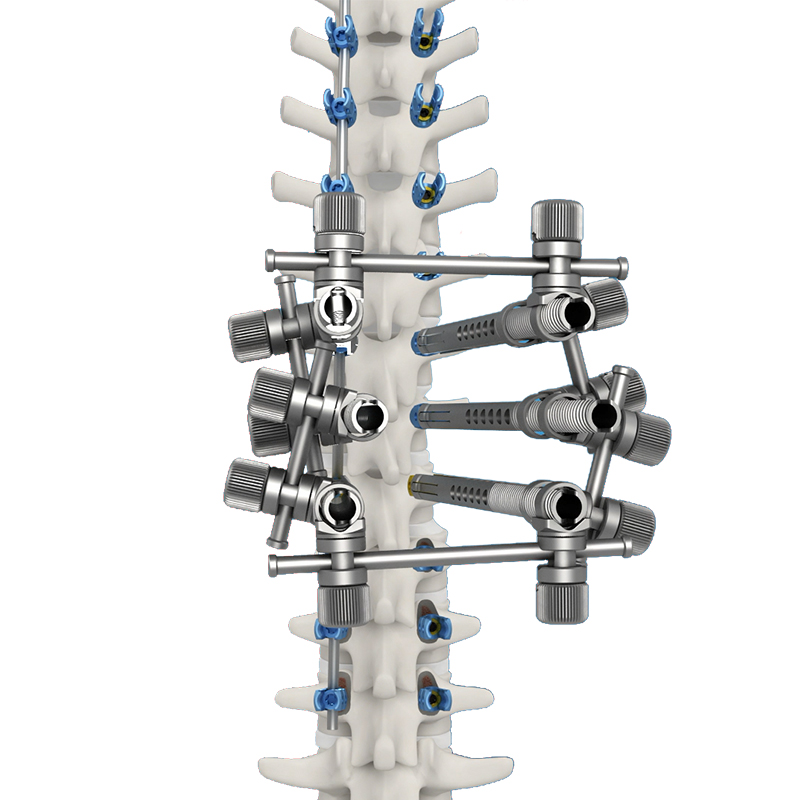Ti Posterior Rod-Screw for Spinal Deformity (5.5 System)