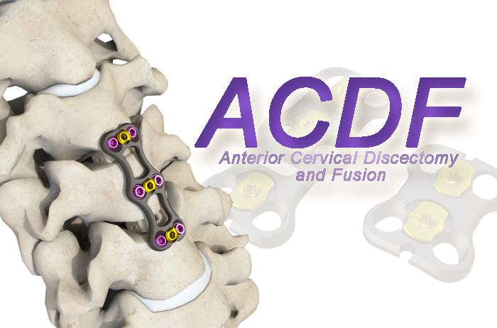 The Importance of ACDF Plates in Today's Cervical Spine Surgery