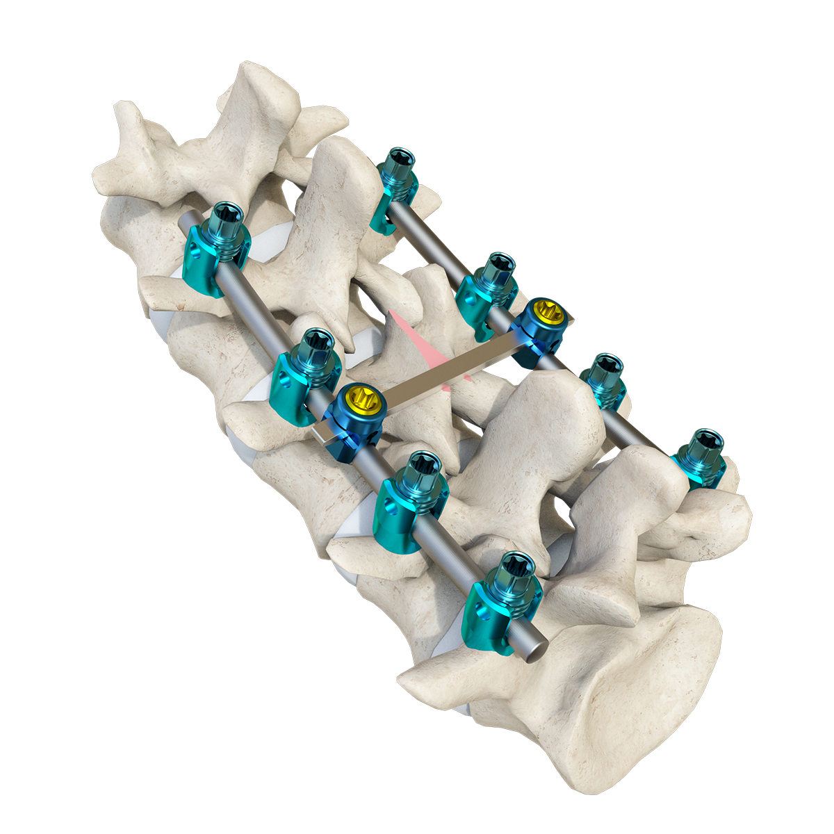 Luna Posterior Thoracolumbar Spinal System